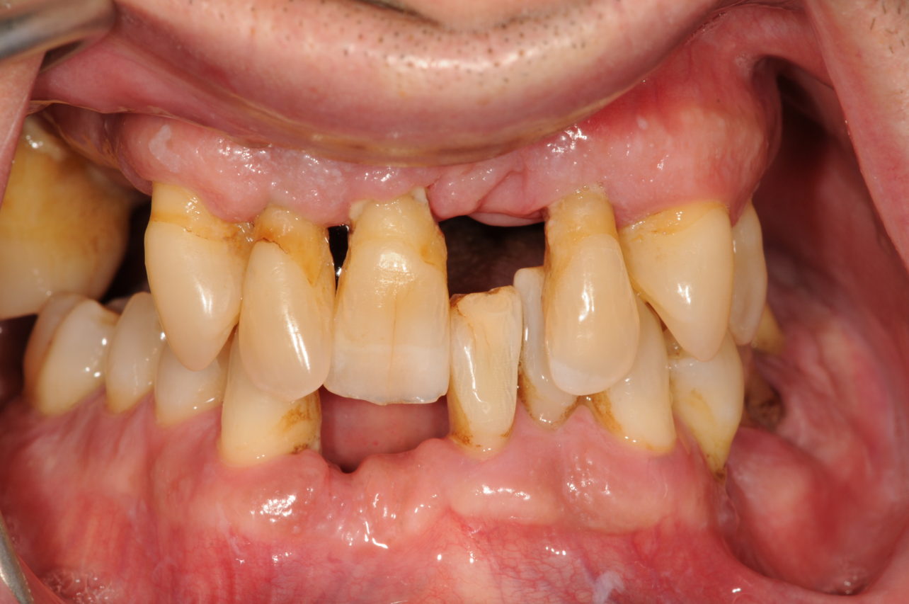 Extreme Makeover : Amazing Results, Patient Had Neglected Teeth For ...